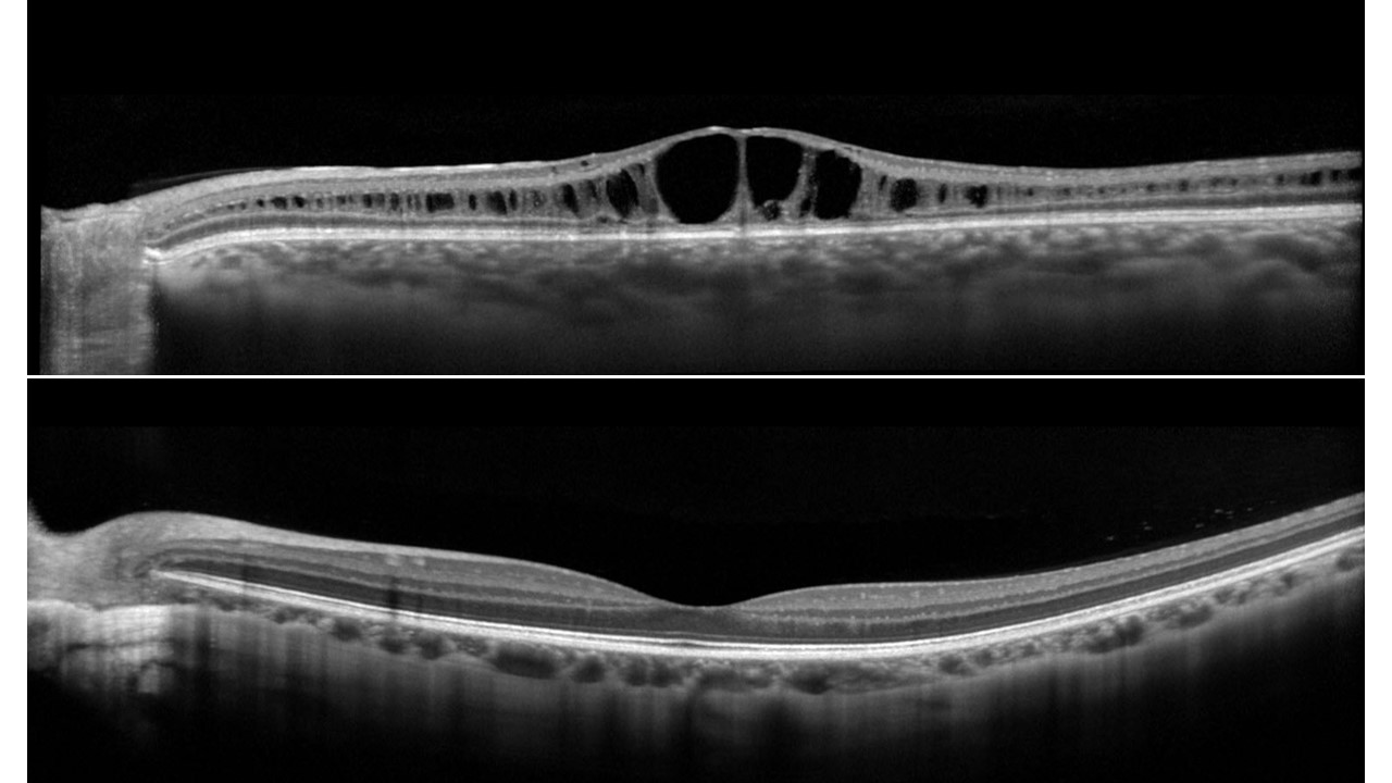 Advancing Gene Therapy